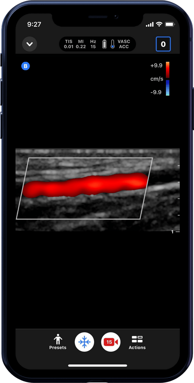 Butterfly iQ3™ Portable Ultrasound Device – 1 or 2 Probes – The Digital ...